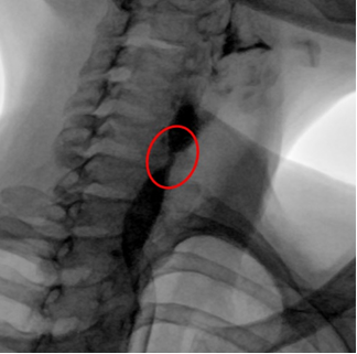 Síndrome de Plummer-Vinson. Informe de caso | Suárez Oceguera | Revista ...