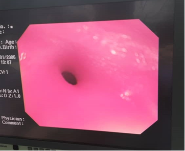 Síndrome de Plummer-Vinson. Informe de caso | Suárez Oceguera | Revista ...